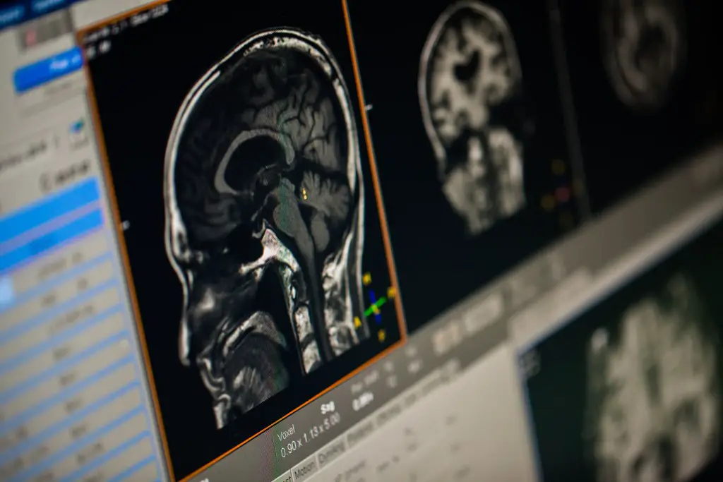 Neuro NCLEX Questions