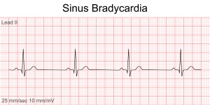 Comprehensive Guide to Sinus Bradycardia for NCLEX Questions: Causes ...